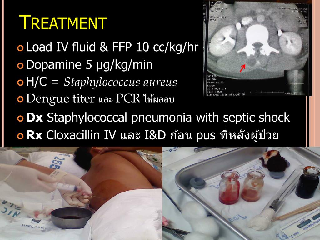 PPT - DENGUE HEMORRHADGIC FEVER DHF PowerPoint Presentation, free ...