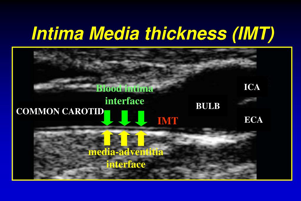 PPT - Is carotid intima media thickness a clinical marker of evolutive ...