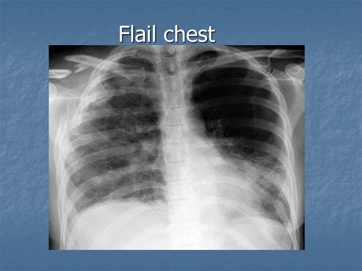 PPT - Chest Trauma PowerPoint Presentation - ID:5256627
