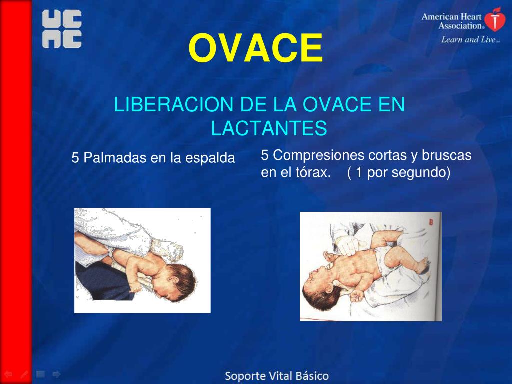 PPT - OVACE OBSTRUCCIÓN DE LA VÍA AÉREA POR CUERPO EXTRAÑO PowerPoint ...