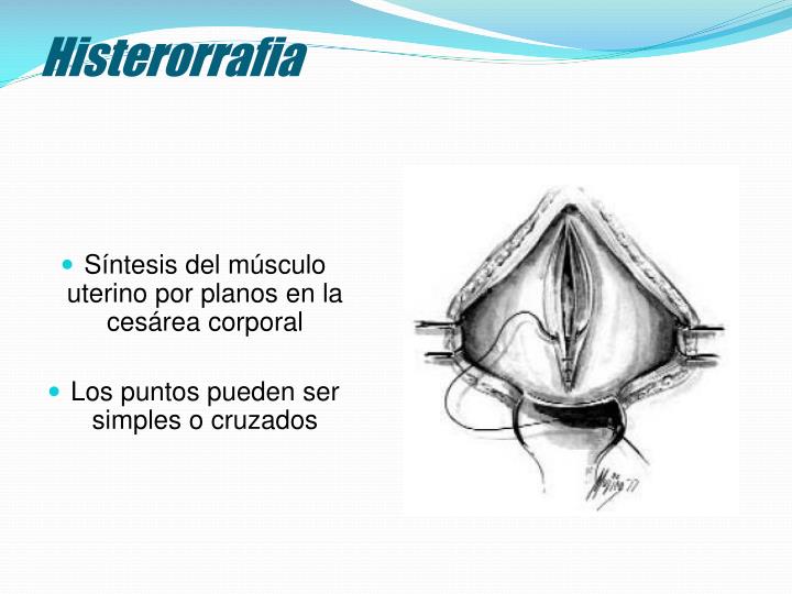 PPT - Operación Cesárea PowerPoint Presentation - ID:5264648