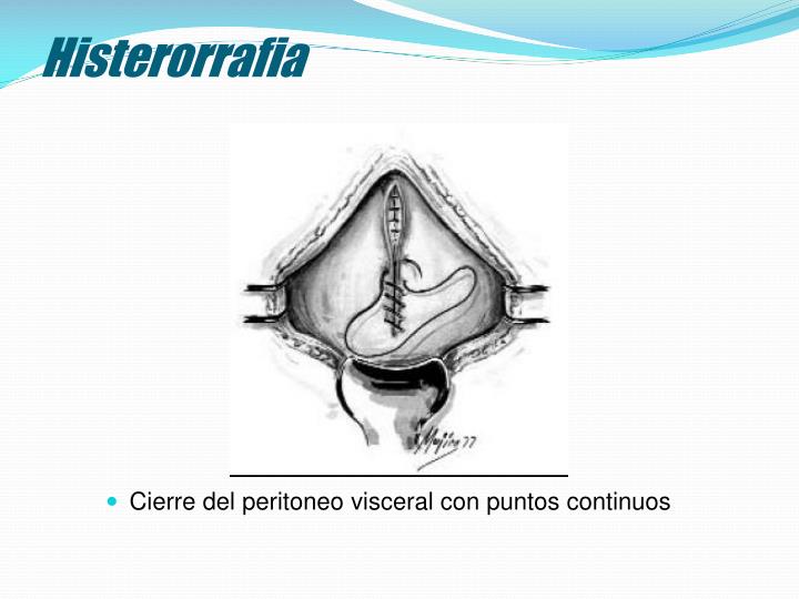 PPT - Operación Cesárea PowerPoint Presentation - ID:5264648
