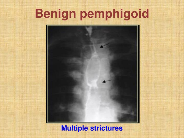 PPT - Diseases of Esophagus & Dysphagia PowerPoint Presentation - ID ...