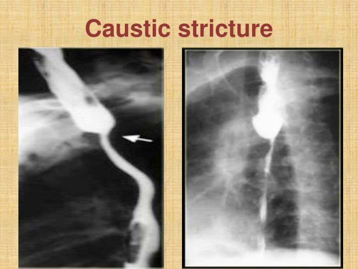 PPT - Diseases of Esophagus & Dysphagia PowerPoint Presentation - ID ...