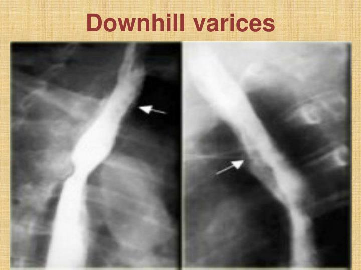 PPT - Diseases of Esophagus & Dysphagia PowerPoint Presentation - ID ...