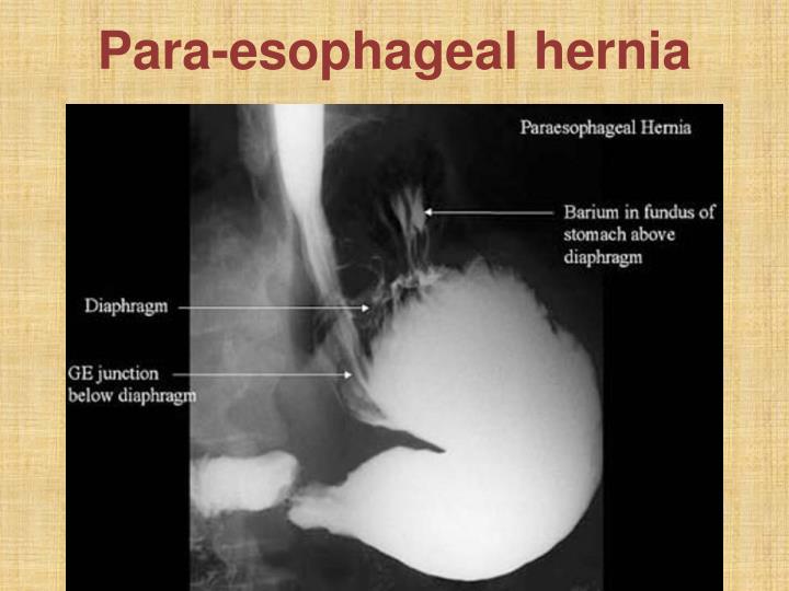 PPT - Diseases of Esophagus & Dysphagia PowerPoint Presentation - ID ...
