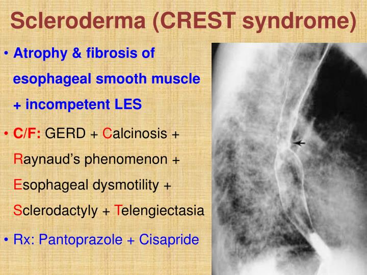 Esophageal Dysmotility