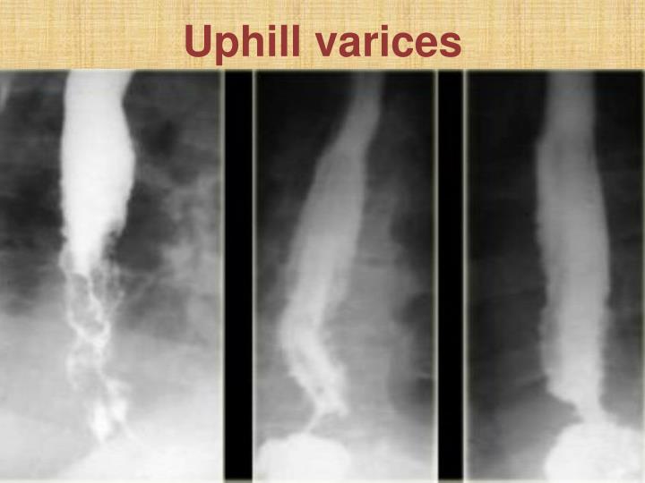PPT - Diseases of Esophagus & Dysphagia PowerPoint Presentation - ID ...