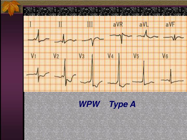 PPT - Arrhythmia PowerPoint Presentation - ID:5278193