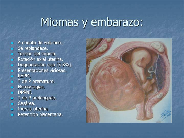 PPT - MIOMATOSIS UTERINA PowerPoint Presentation - ID:5278575