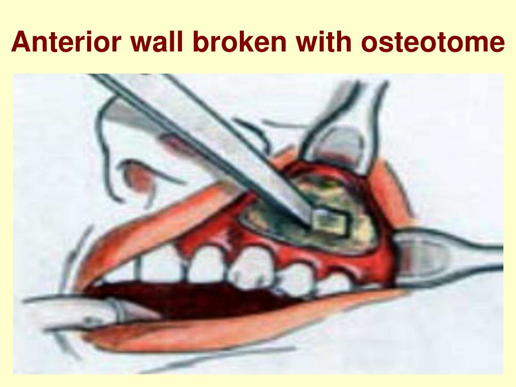 PPT - Surgical Treatment of Sinusitis PowerPoint Presentation, free ...