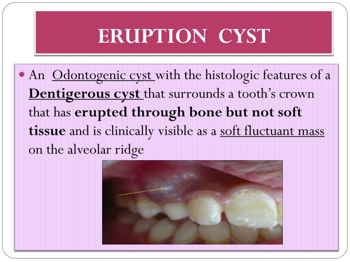 PPT - Cysts of jaws PowerPoint Presentation - ID:5296491