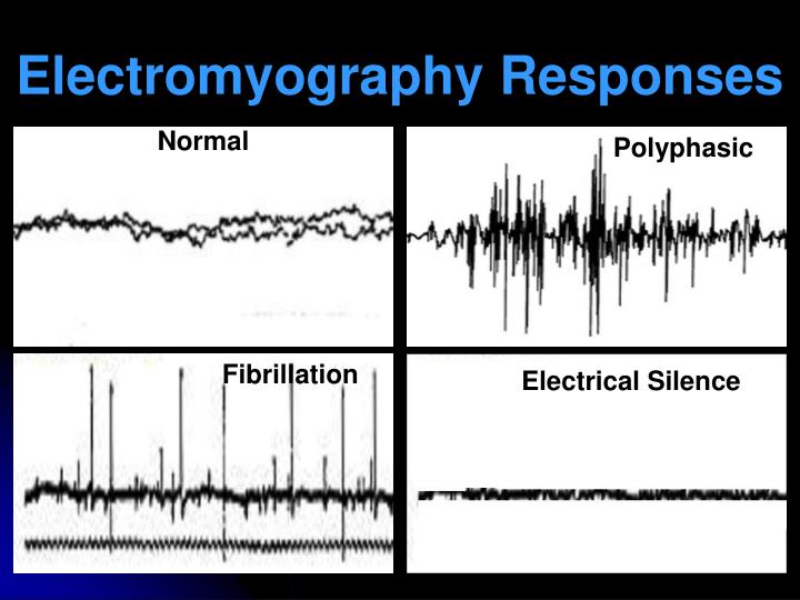 PPT - Facial Nerve Paralysis PowerPoint Presentation - ID:5299690