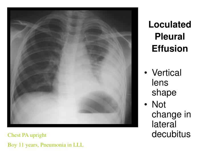 PPT - Pleural effusion in major fissure PowerPoint Presentation - ID ...