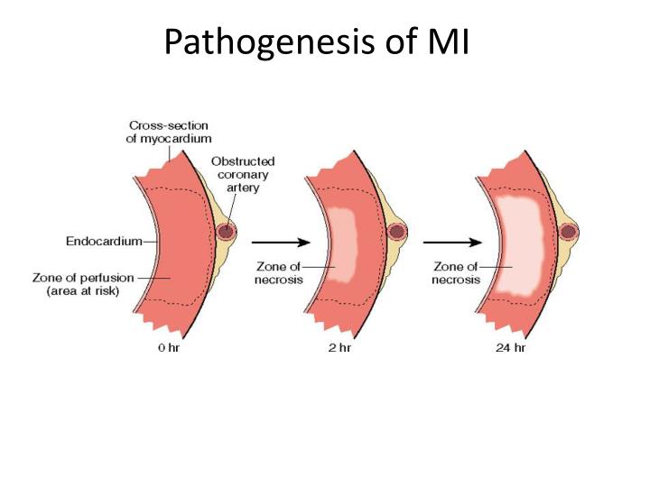 PPT - Myocardial Infarction PowerPoint Presentation - ID:5309192