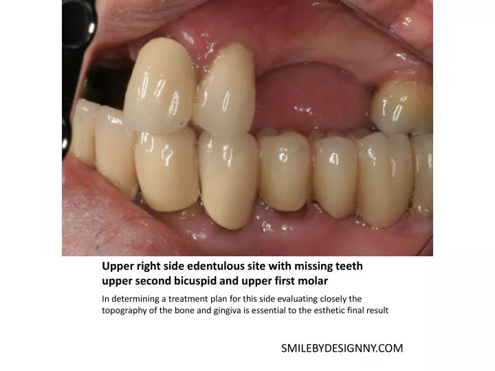 PPT - Upper right side edentulous site with missing teeth upper second ...
