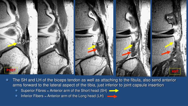 PPT - Posterolateral Corner of the Knee: MRI, Anatomy, Functional ...
