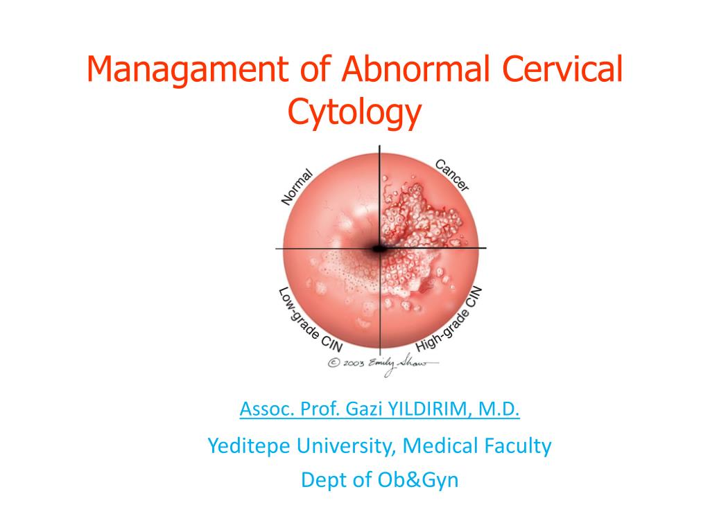 Ppt Managament Of Abnormal Cervical Cytology Powerpoint Presentation