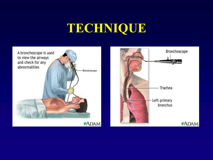 PPT - BRONCHOSCOPY PowerPoint Presentation - ID:5317592