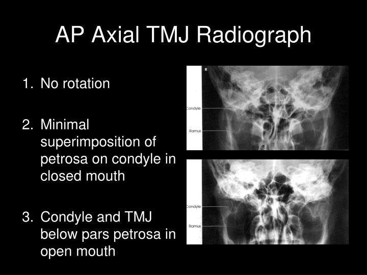 PPT - Week 11 : TMJ PowerPoint Presentation - ID:5317967