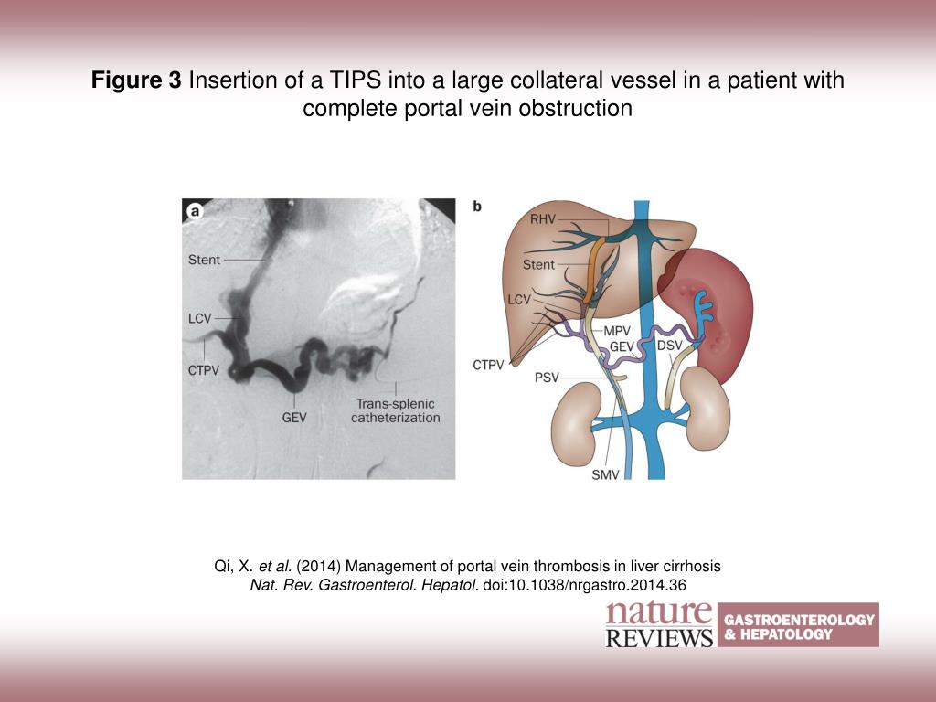 Ppt Qi X Et Al 2014 Management Of Portal Vein Thrombosis In