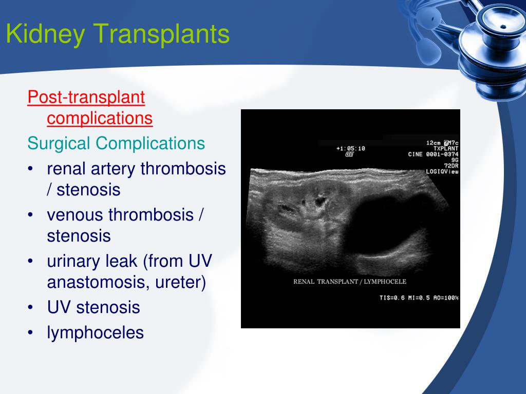 PPT - Clinical Management of Kidney Transplants PowerPoint Presentation ...
