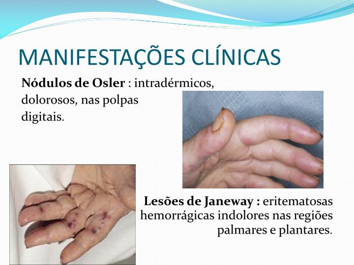 PPT - ENDOCARDITE INFECCIOSA PowerPoint Presentation - ID:5330158