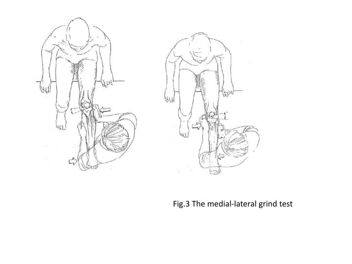 PPT - Fig. 2 . The McMurray test for meniscal tears. PowerPoint ...