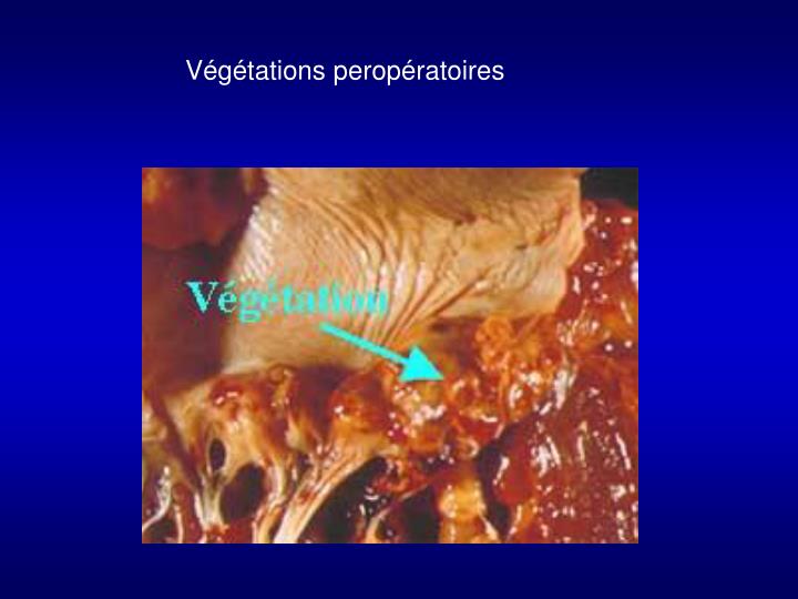 PPT - ENDOCARDITE INFECTIEUSE PowerPoint Presentation - ID:5330779