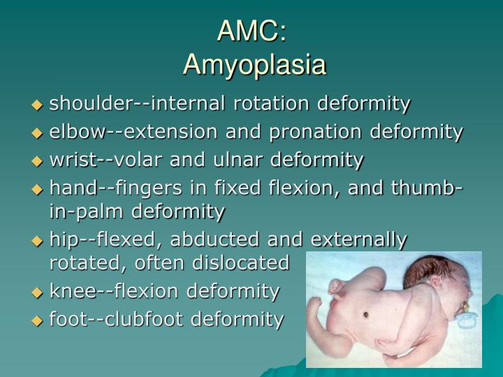 PPT - Neonatal Orthopedic Issues PowerPoint Presentation - ID:5335544