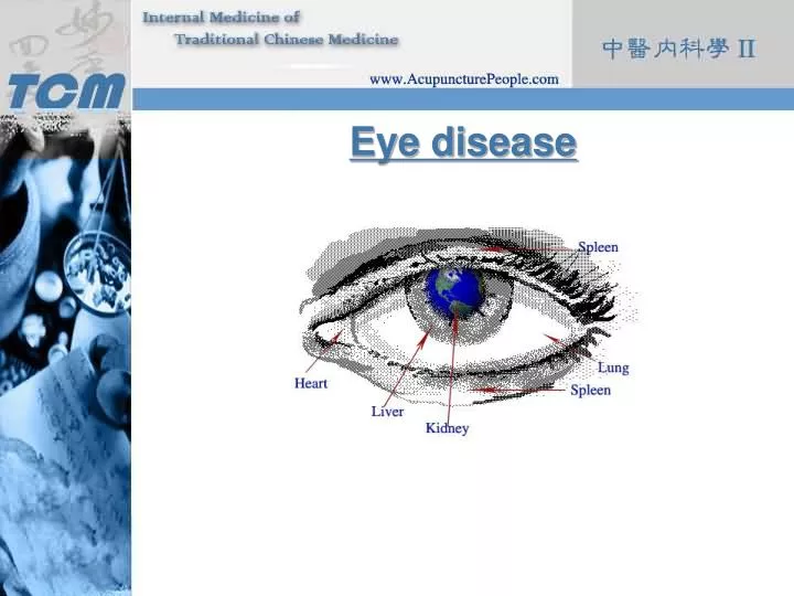 PPT - Eye disease PowerPoint Presentation, free download - ID:5341627