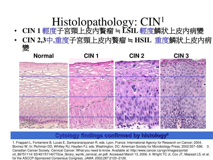 PPT - 子宮頸癌病程演進自然史 PowerPoint Presentation - ID:5342031