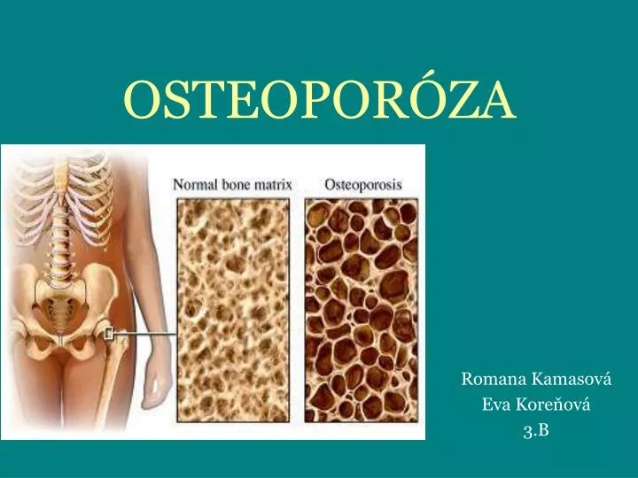 PPT - OSTEOPORÓZA PowerPoint Presentation, free download - ID:5342807