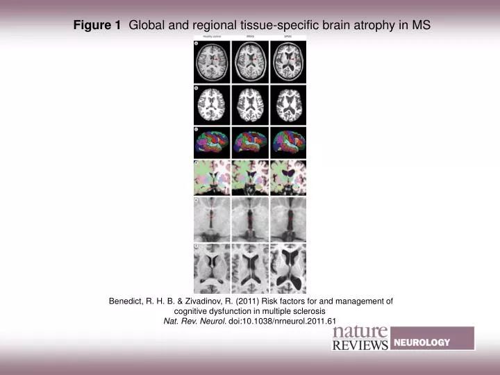 PPT - Figure 1 Global and regional tissue-specific brain atrophy in MS ...