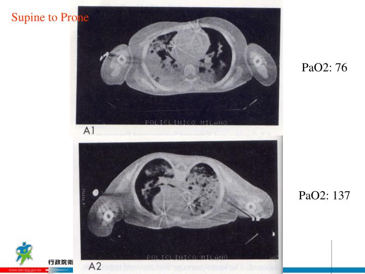PPT - Prone position for Acute Respiratory Distress Syndrome PowerPoint ...