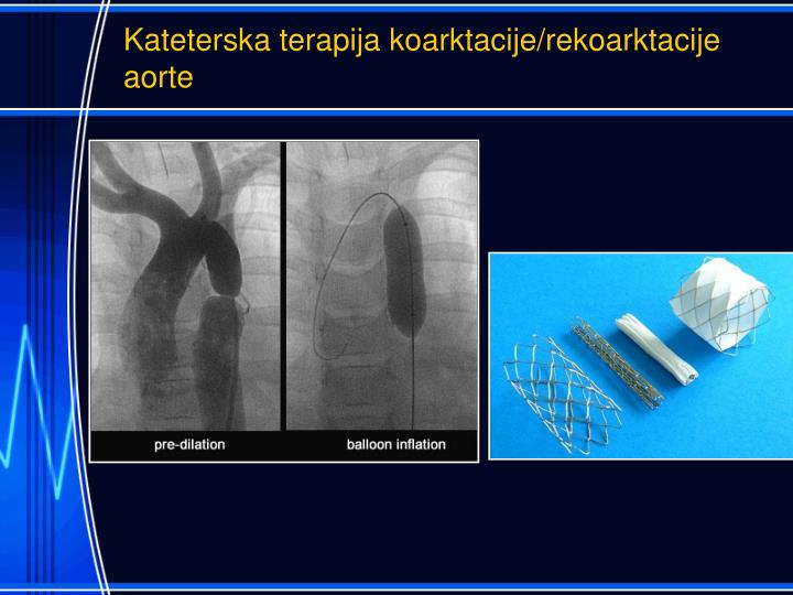 PPT - INTERVENTNA PEDIJATRIJSKA KATETERIZACIJA SRCA PowerPoint ...