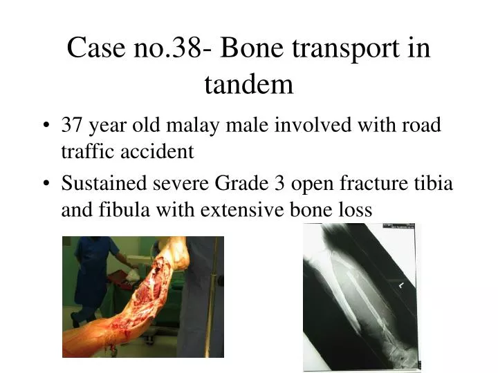 PPT - Case no.38- Bone transport in tandem PowerPoint Presentation ...