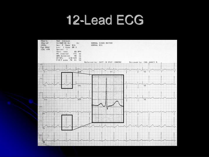 PPT - 12-Lead ECG Interpretation PowerPoint Presentation - ID:5370182