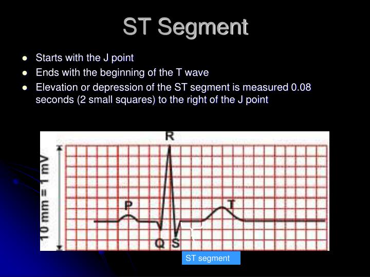 PPT - 12-Lead ECG Interpretation PowerPoint Presentation - ID:5370182