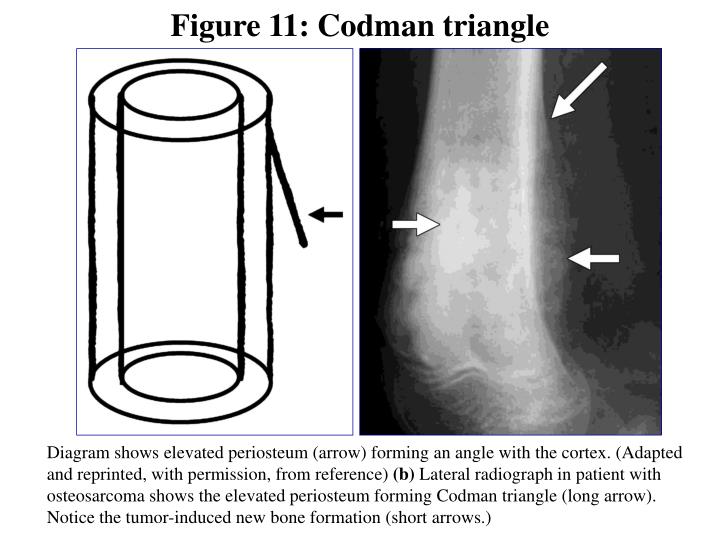 PPT - Table 1. Peak Age Predilection of Bone Lesions PowerPoint ...