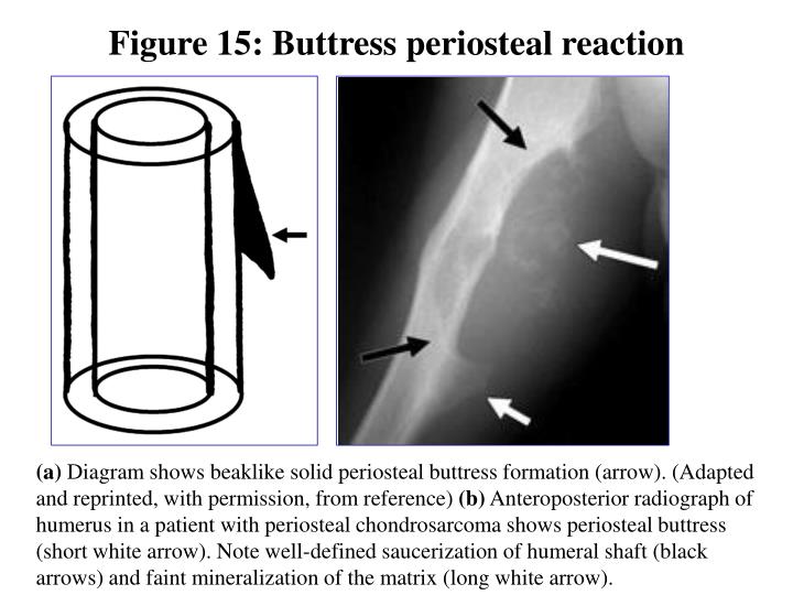 PPT - Table 1. Peak Age Predilection of Bone Lesions PowerPoint ...